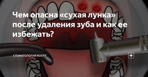 Чем опасна «сухая лунка после удаления зуба и как ее избежать Стоматология Roott Дзен