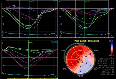 Myocardial Strain Analysis Showing Global Longitudinal Strain Of Download Scientific Diagram