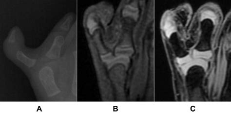 Different Imaging Techniques Of A Case With Radial Polydactyly At The Download Scientific