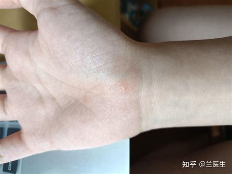 汗疱疹最简单的自愈方法 知乎