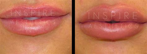 Lip Augmentation 21 Inspire Aesthetics