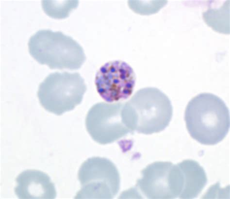 Plasmodium Malariae Parasite Diagnosis