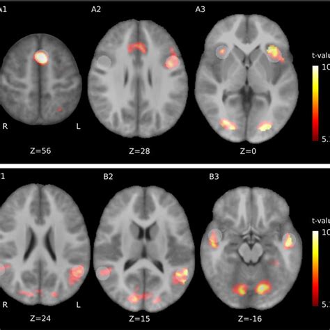 Activation Maps Pooled Activation Maps Ie Patients And Controls