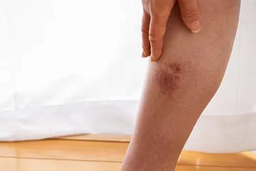Cellulitis Symptoms Causes Treatments And More