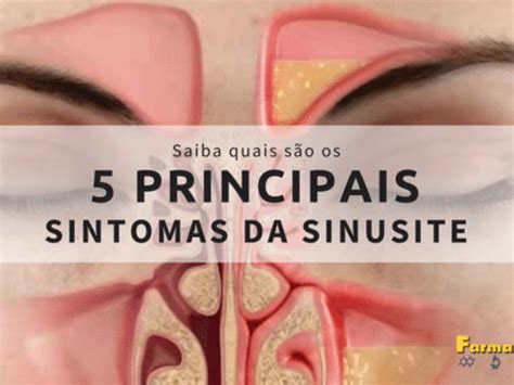 Saiba Quais S O Os Principais Sintomas Da Sinusite Dicas De Sa De Brentwooddental Com