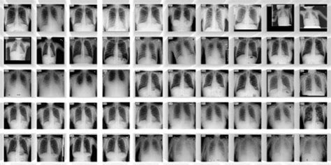 Nih Chest X Ray Dataset Machine Learning Datasets