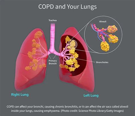 Copd Lung Surgery