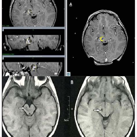 A Stereotactic 3d T1 Weighted Contrast Enhanced Mri In Gamma Plan Of Download Scientific