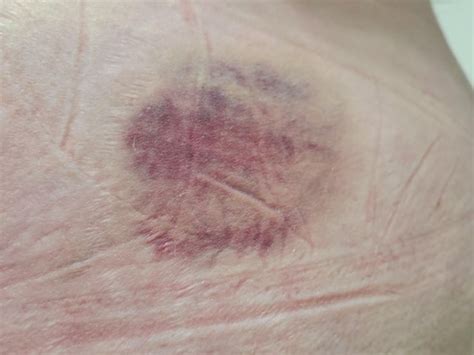 Bruising From Injection R Zepbound