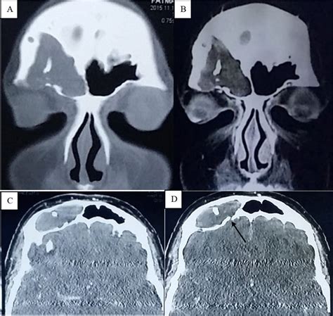 Ct Scan Bone A And Soft Tissue Bd Windows Showing A Soft Tissue