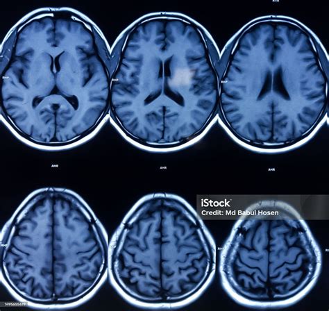 뇌의 자기 공명 영상 스캔 뇌 부비동 안구 및 두개골을 보여줍니다 Mri 스캐너에 대한 스톡 사진 및 기타 이미지 Mri 스캐너 건강 검진 건강관리와 의술 Istock
