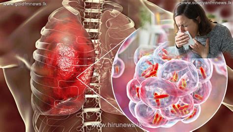 Risk Of Spreading Tuberculosis Hiru News Srilankas Number One News