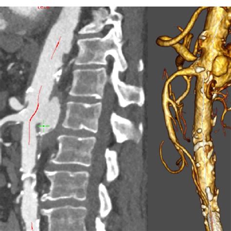 Sagittal Ct Scan And 3d Reconstruction 18 Th March 2022 Showing