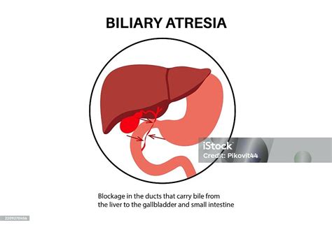 Biliary Atresia Disease Stock Illustration Download Image Now