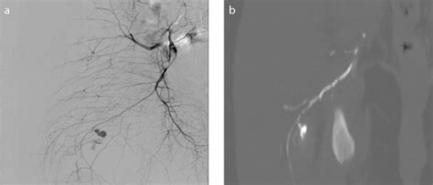 Introducing Phil Precipitating Hydrophobic Injectable Liquid A New Embolic Agent For The