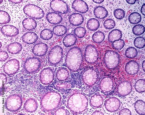 Poster Colon Chronic Inflammation Wall Art Ukposters