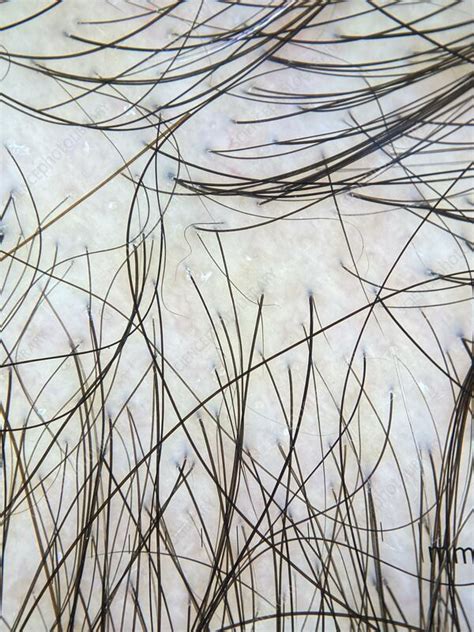 Female Pattern Hair Loss Dermoscopy Stock Image C060 3911 Science Photo Library