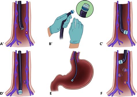 A Targeted Endoscopic Band Ligation Technique For Management Of Acute Esophageal Variceal
