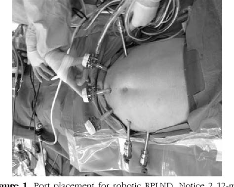 Table 1 From Supine Robotic Assisted Retroperitoneal Lymph Node Dissection For Testicular Cancer