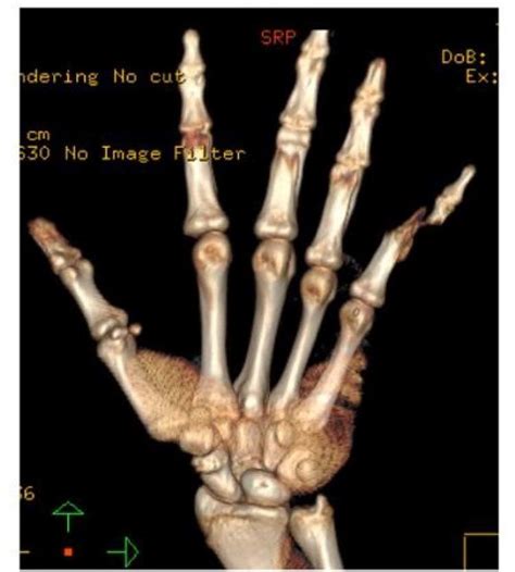 Ct Scan Of The Left Wrist Download Scientific Diagram