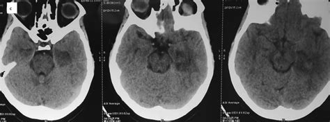A B Initial Non Contrast Ct Scan Of Brain Showing Hyperdensity In Left Download Scientific