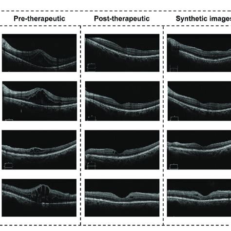 Illustration Of The Synthetic Oct Images With Different Types Of