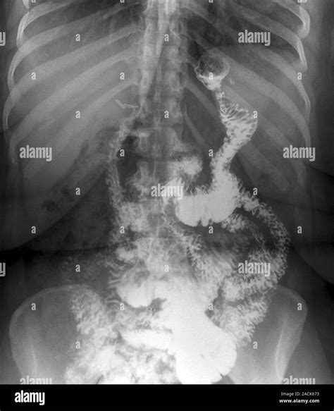 Gastric Bypass Surgery Frontal X Rays Of A 48 Year Old Obese Patient Showing The Upper