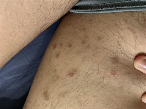 Dry Skin Rashes During Winter 😩 Help Me Rdermatologyquestions