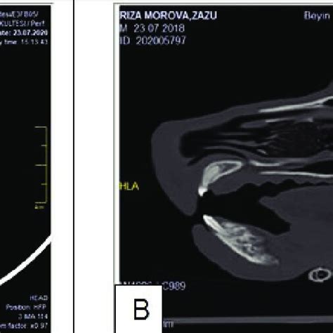 Ct Image Of Dermoid Cyst A Transverse Plane B Sagittal Plane No