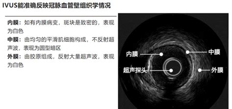 一文读懂认识血管内超声（ivus） 器械之心