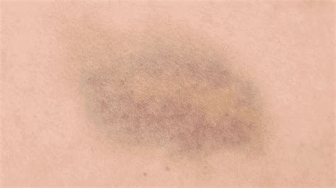 Apa Itu Lentigo Ini Gejala Penyebab Dan Cara Mengatasinya