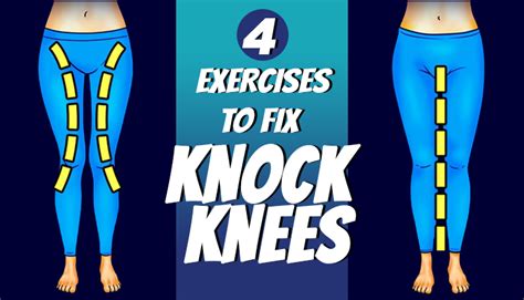 6 Best Knock Knee Exercises To Fix Posture At Home An Tâm