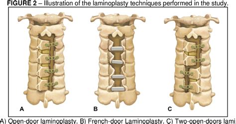 Figure 2 From Comparison Of Cervical Laminoplasty Techniques In
