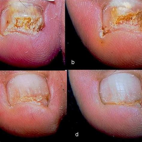 Pdf Refractory Onychomycosis Due To Trichophyton Rubrum Combination