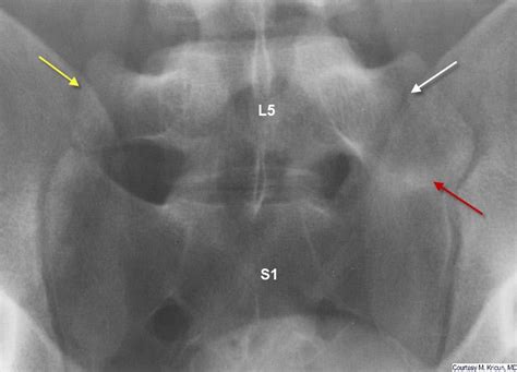 Transitional Lumbosacral Vertebra Medical Information Back Pain