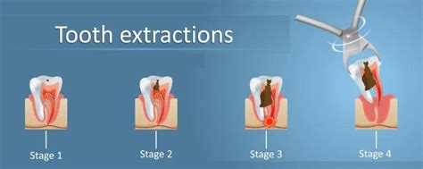 Tooth Extraction And Rct Preserving Your Natural Tooth