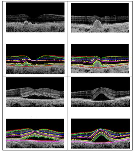 1 four examples of automated segmentation results on attenuation