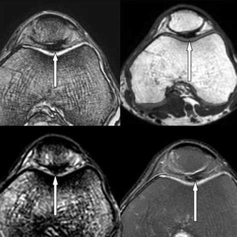 A T2 W Sagittal Image Of The Right Knee Obtained With A Gradient