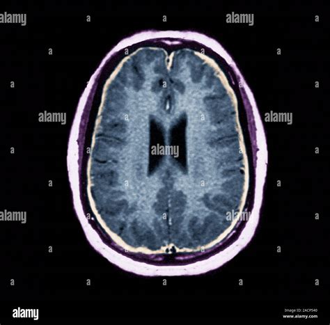 Bacterial Meningitis Coloured Magnetic Resonance Imaging Mri Scan Of