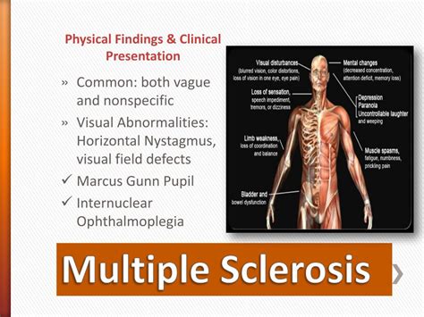PPT Multiple Sclerosis PowerPoint Presentation Free Download ID