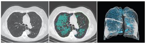Ai Can Enhance Accuracy Of Ct Scans In Emphysema Physics World