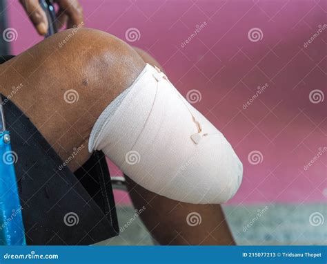 Elastic Bandaged Below Knee Amputation Stock Image Image Of Care Adult 215077213