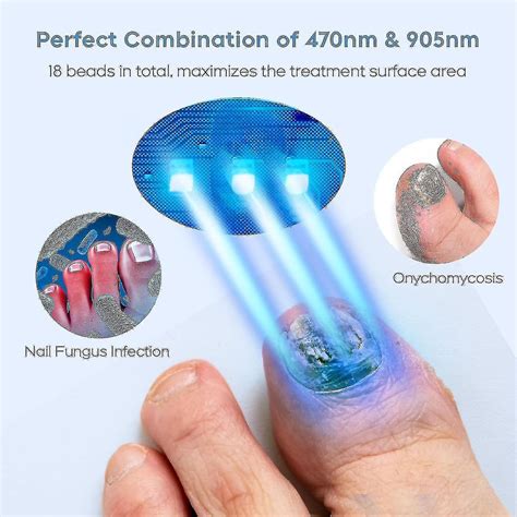 2024 Nail Fungus Laser Treatment Device For Multiple Toenail Home Use