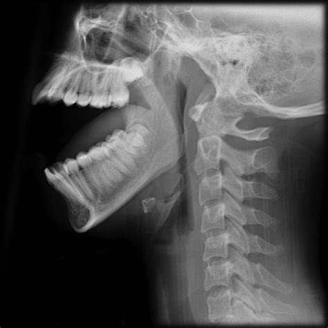 Bilateral Temporomandibular Joint Dislocation Buyxraysonline