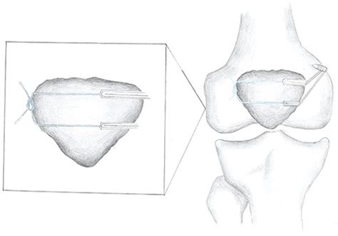 Frontiers Active Exercise Therapy Improves The Recovery Of Knee Joint