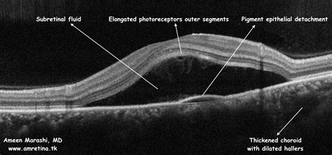 Acute Central Serous Chorioretinopathy Fundus Image Oct And Ffa In A Nutshell