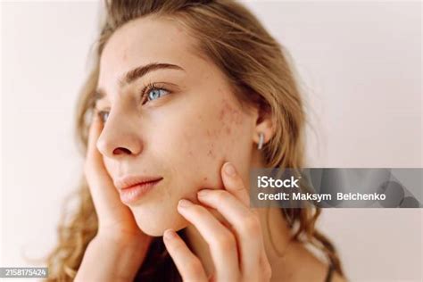 여자는 얼굴에 붉은 반점이 있는 화장을 하지 않습니다 건강 문제 피부병 건강관리와 의술에 대한 스톡 사진 및 기타 이미지 건강관리와 의술 건강한 생활방식 관해 의술