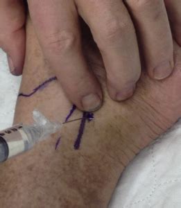 Diagnostic Posterior Tibial Nerve Block Sports Medicine Review