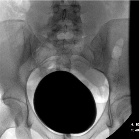 Micturating Cystogram Mcu Showing An Even Delimited Bladder Without