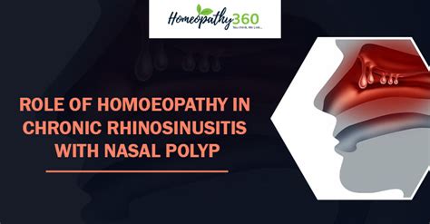 Role Of Homoeopathy In Chronic Rhinosinusitis With Nasal Polyp